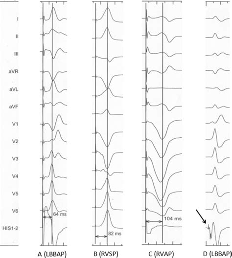 Sti Lvat Of The Three Pacing Positions During Lead Implantation A