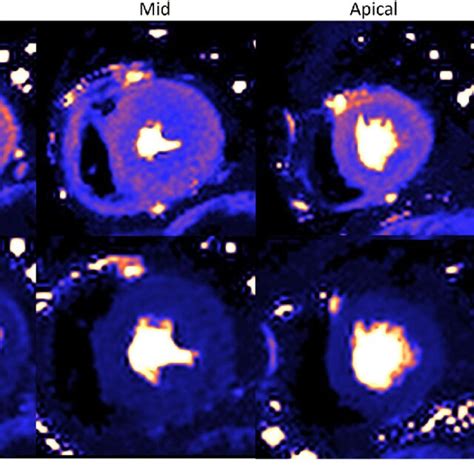 Example Of Abnormal Perfusion Scanning Results On Cardiac MRI The Download Scientific Diagram