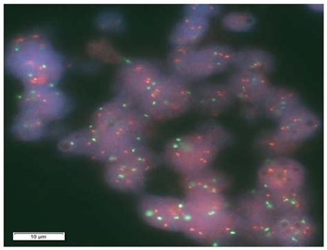 Human Epidermal Growth Factor 2 Her2 Gene Amplification By