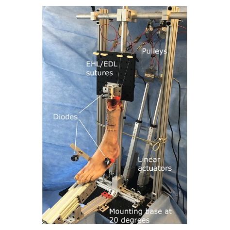 Forefoot Extensor Tendon Transfers Fixed With Biocomposite Interference