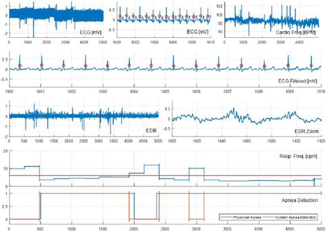 Example Of Qrs Detection Red Dots Ecg Derived Respiration Edr Download Scientific Diagram