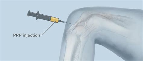 Hyaluronic Injection Fenland Physio Physiotherapy In Ely