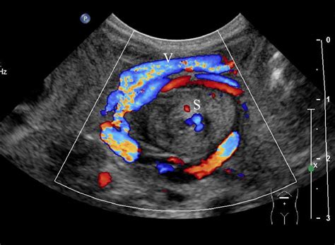 Ultrasound Imaging As The First Line Of Investigation To Diagnose
