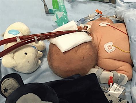 Extra Corporeal Membrane Oxygenation For Neonatal Respiratory Support