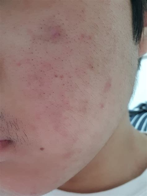 얼굴 빨간 여드름 자국 지식in