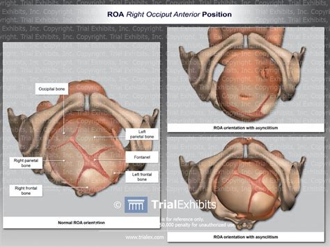 Roa Right Occiput Anterior Position Trialquest Inc