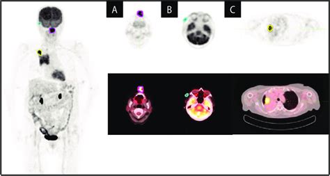 A Focal Uptake Into A Nasal Cavity With Suvmax Up To 10 11 B