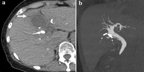 Drip Infusion Cholangiography Ct An Unopacified Dilated Bile Duct