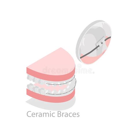 3d Isometric Flat Vector Illustration Of Dental Teeth Braces Types Item 2 Stock Vector