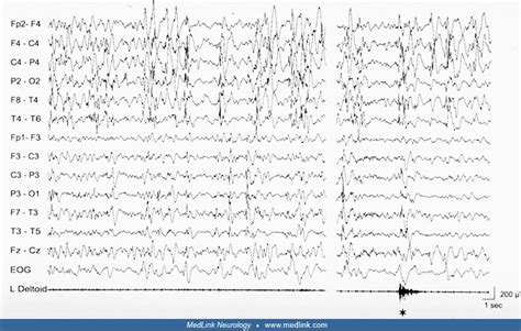 Porencephaly Medlink Neurology