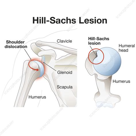 Hill Sachs Lesion Of The Shoulder Illustration Stock Image C058