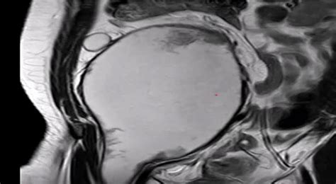 Mri Showing Right Psoas Abscess Transverse Section At The Level Of