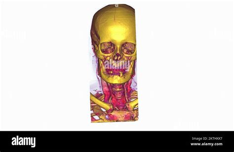 Skull Cross Section Enhanced Ct Scan Stock Video Footage Alamy