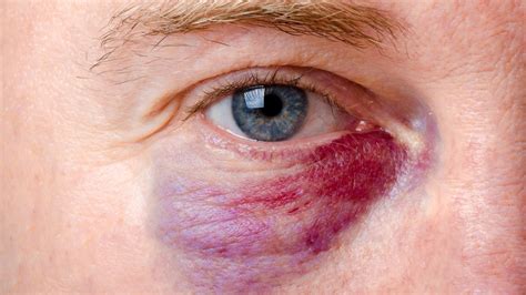 Eye Injuries Articles On Protection Treatment And Emergency Care