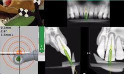 Dynamic Navigation For Orthograde And Retrograde Endodontics