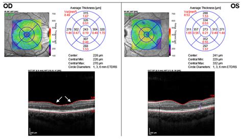 Case Report Paracentral Acute Middle Maculopathy Associated With