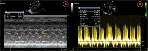 A The Mitral Valve Shows Slow Early Diastolic Closure On An M Mode