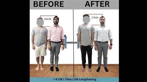 Signs Of Height Increase At Robin Alexander Blog