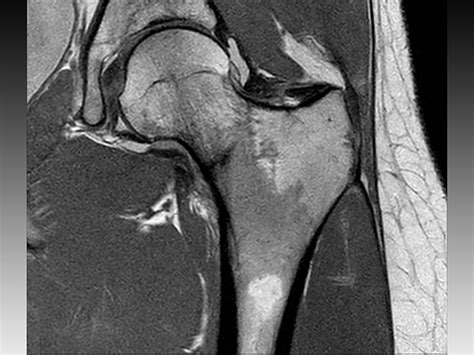 Bone Infarct Femur