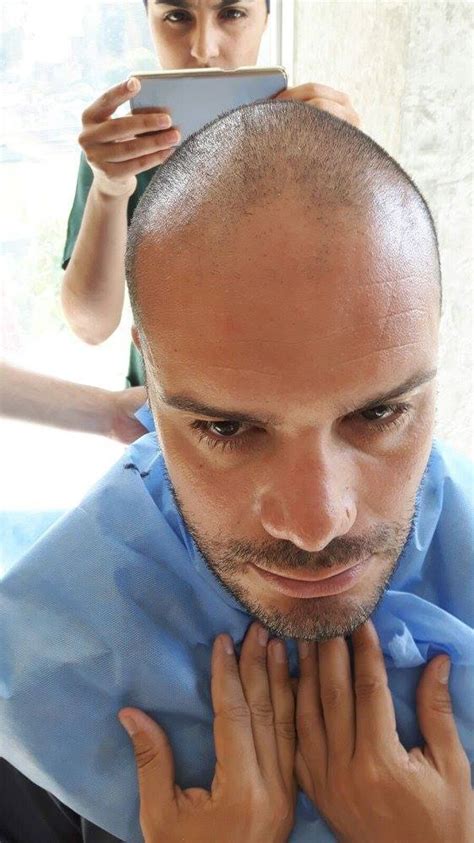 Newhair Trapianto Capelli In Turchia Di Lorenzo Renzi Aka Sergio Buffoni Facebook
