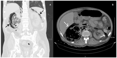 Massive Emphysematous Pyelonephritis The Western Journal Of Emergency Medicine