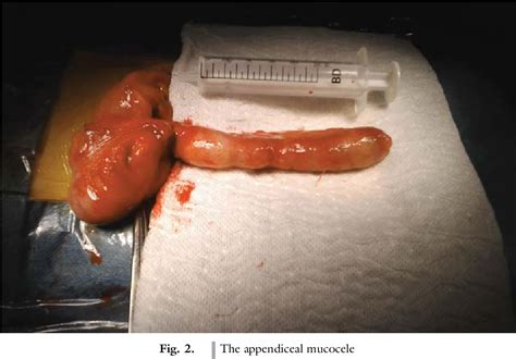 Figure 2 From Giant Appendix Or An Appendiceal Mucocele Case Report Of