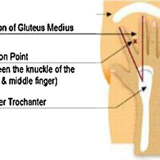 Pdf Using Ventrogluteal Site In Intramuscular Injections Is A