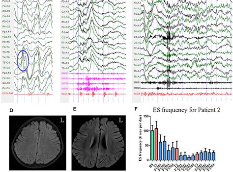 Eeg Vs Mri For Seizures Mapasgmaes