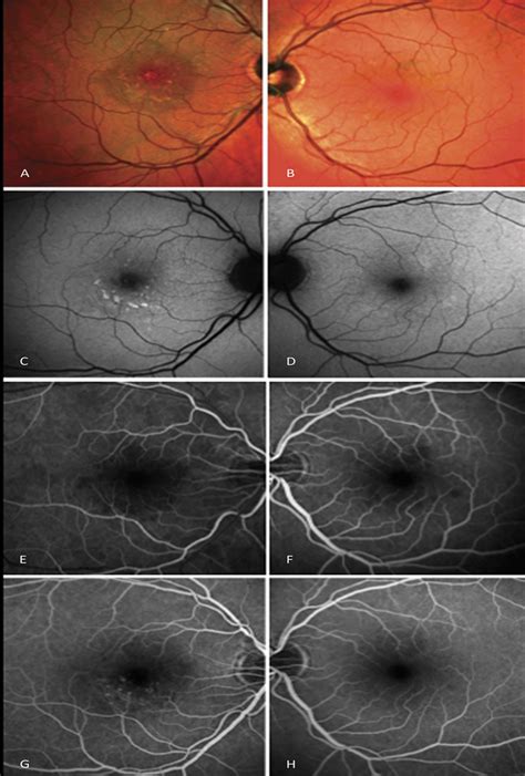 Persistent Placoid Maculopathy Imaged By Optical Coherence T