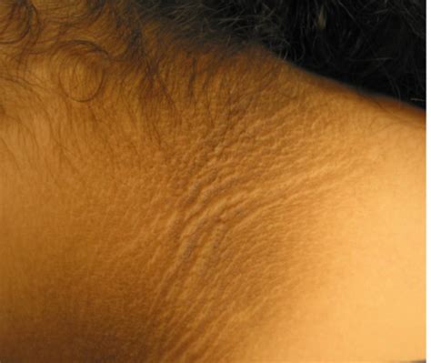 Dm Type 1 And 2 Dm Complications Flashcards Quizlet