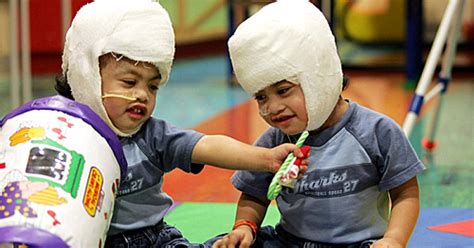 머리 정수리 붙은 쌍둥이형제 분리수술후 10년째 생존한 명은 장애 남아