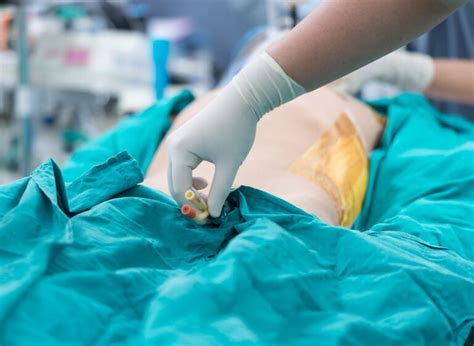 Tips Dan Trik Memasang Kateter Di Rumah Dari Kavacare