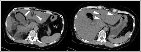 Secondary Sclerosing Cholangitis After Emphysematous Cholecy Acg Case Reports Journal