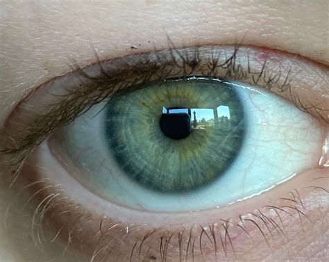 Central Heterochromia Reyes