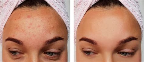 Best Probiotics For Acne 12 That Actually Work Derm And Gut Backed