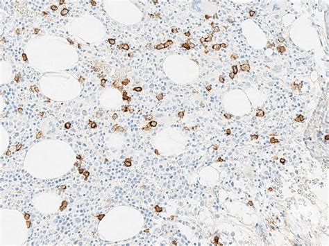 Bone Marrow Biopsy 2
