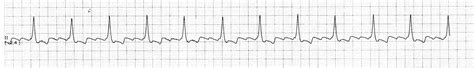 ECG Channel Atrial Flutter