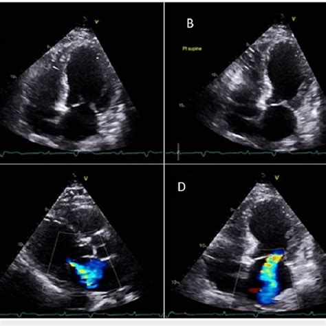 Transthoracic Echocardiogram Apical Four Chamber View In Diastolic A
