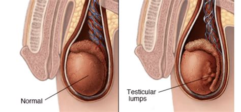 Testicular Cancer Fairbanks Urology