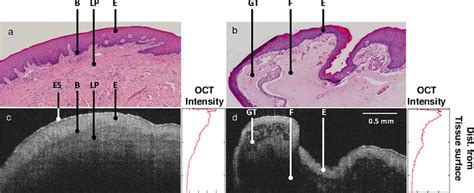 Mucocele Histology