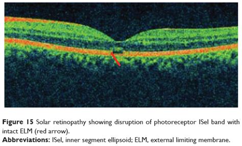 photoreceptor inner segment ellipsoid band integrity on spectral domai