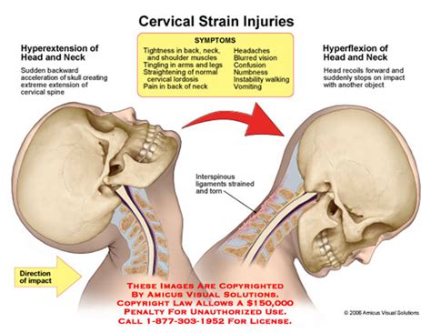 Cervical Strain Injuries