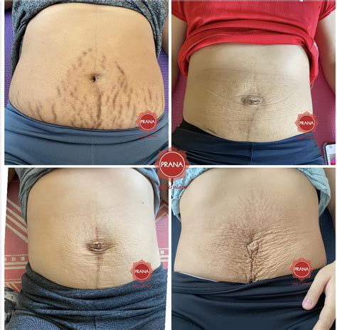 Prana Diastasis Recti Is A Condition Where The Fascia Linea Alba