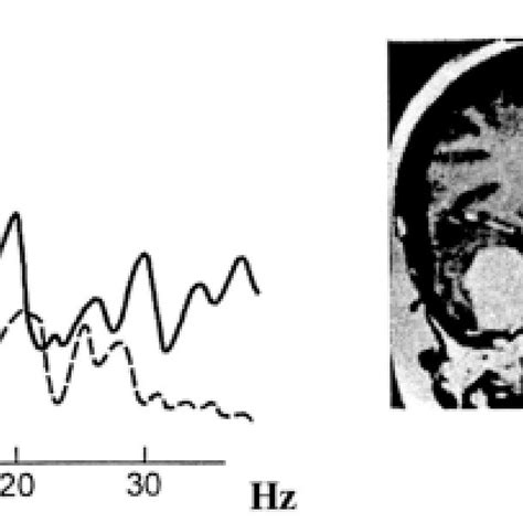 EEG Spectrum Coherence At Temporal Frontal Regions Within The Right And Download Scientific