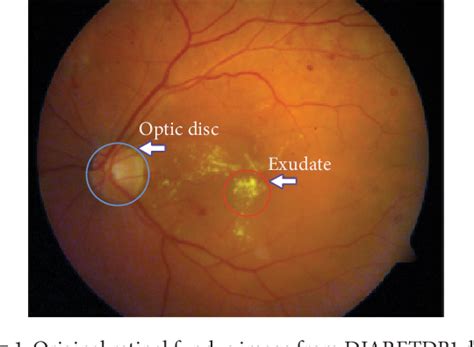 Figure 1 From Automatic Detection Of Optic Disc In Retinal Image By Using Keypoint Detection