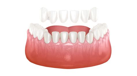 Dental Crowns Antalya Dent Smile