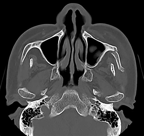 Ct Image At Initial Examination The Left Zygomatic Maxillary Suture