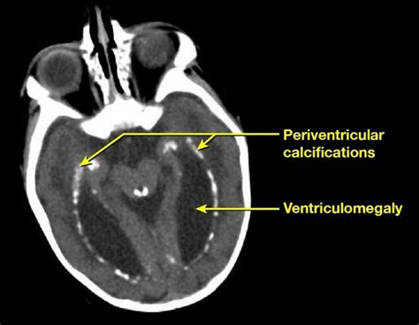 Cmv Periventricular Calcification