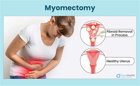 Myomectomy Procedure Indications Steps Recovery Time