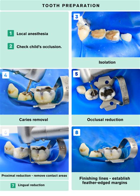 Crowns For Primary Teeth Stainless Steel Crowns Pediatric Dentistry